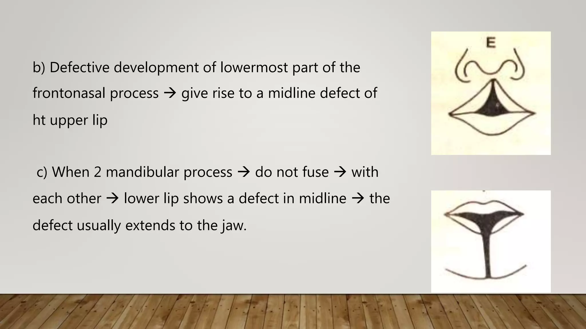 Developmental Disturbances of The Face | PPTX