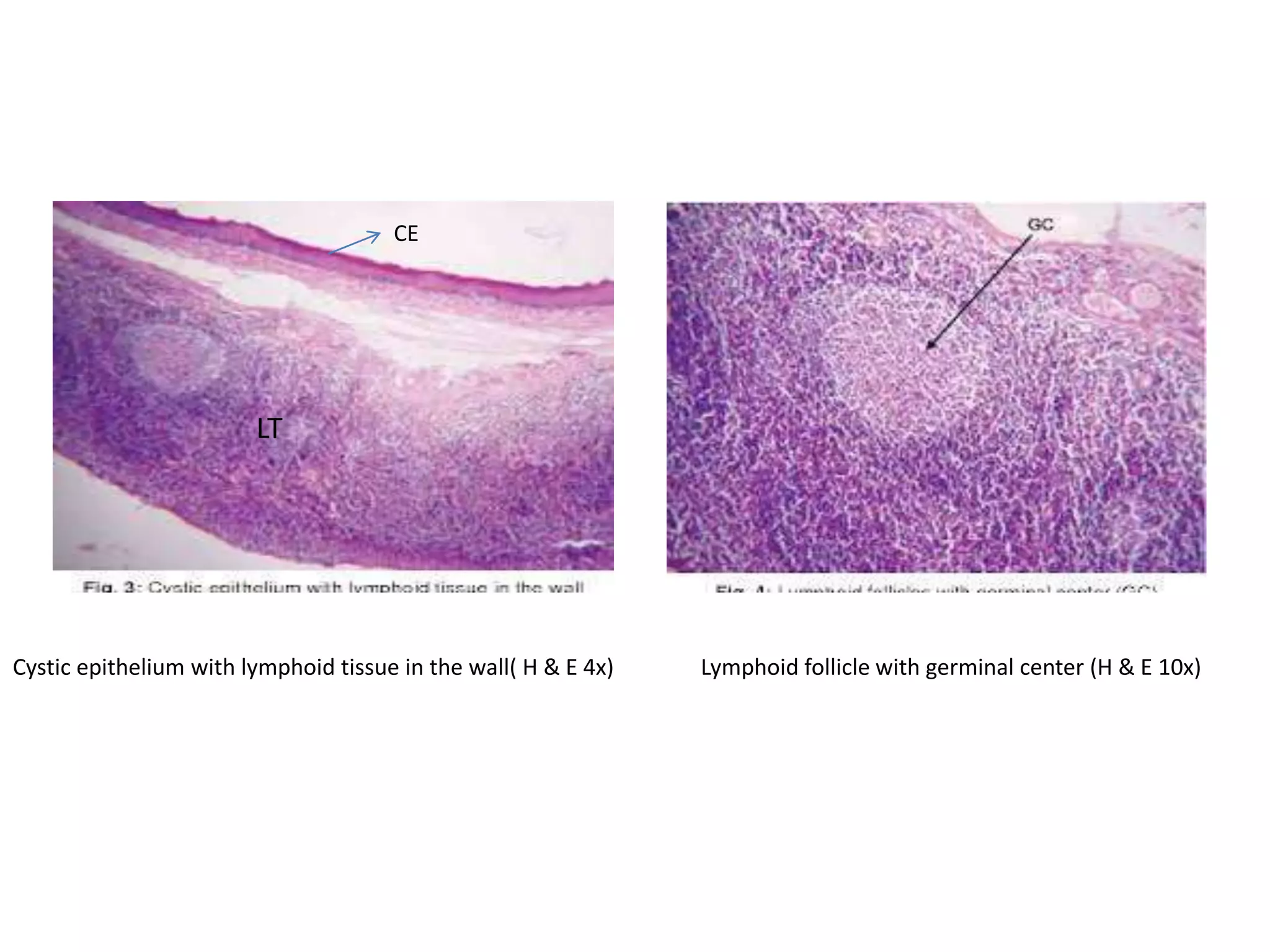 Developmental disturbance of Oral Lymphoid tissue | PPTX