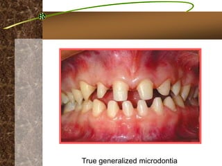 True Generalized Microdontia