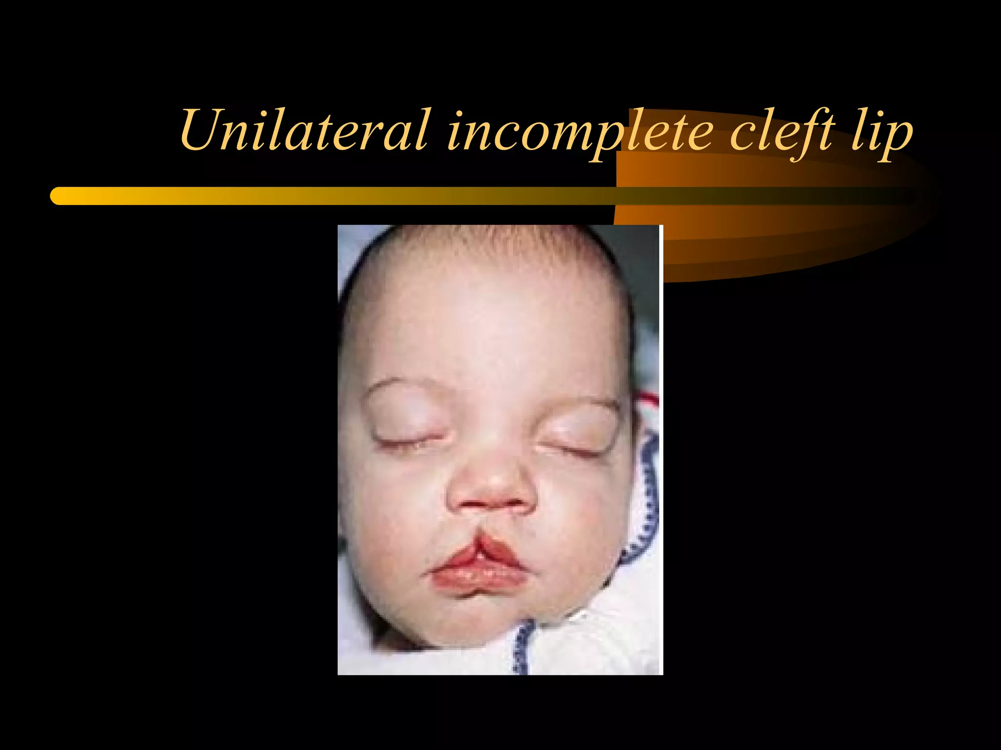 Developmental disorders of orofacial structures dental oral pathology | PPT