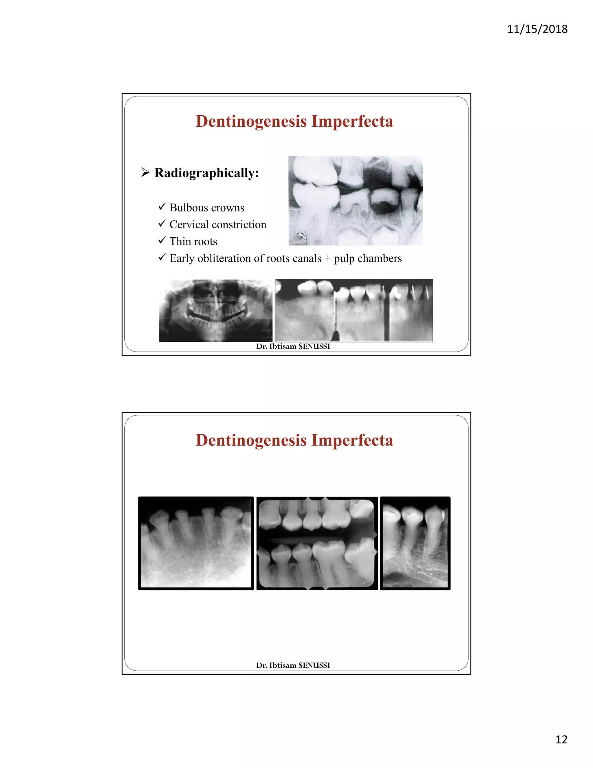 Developmental disturbances - Oral Pathology | PDF