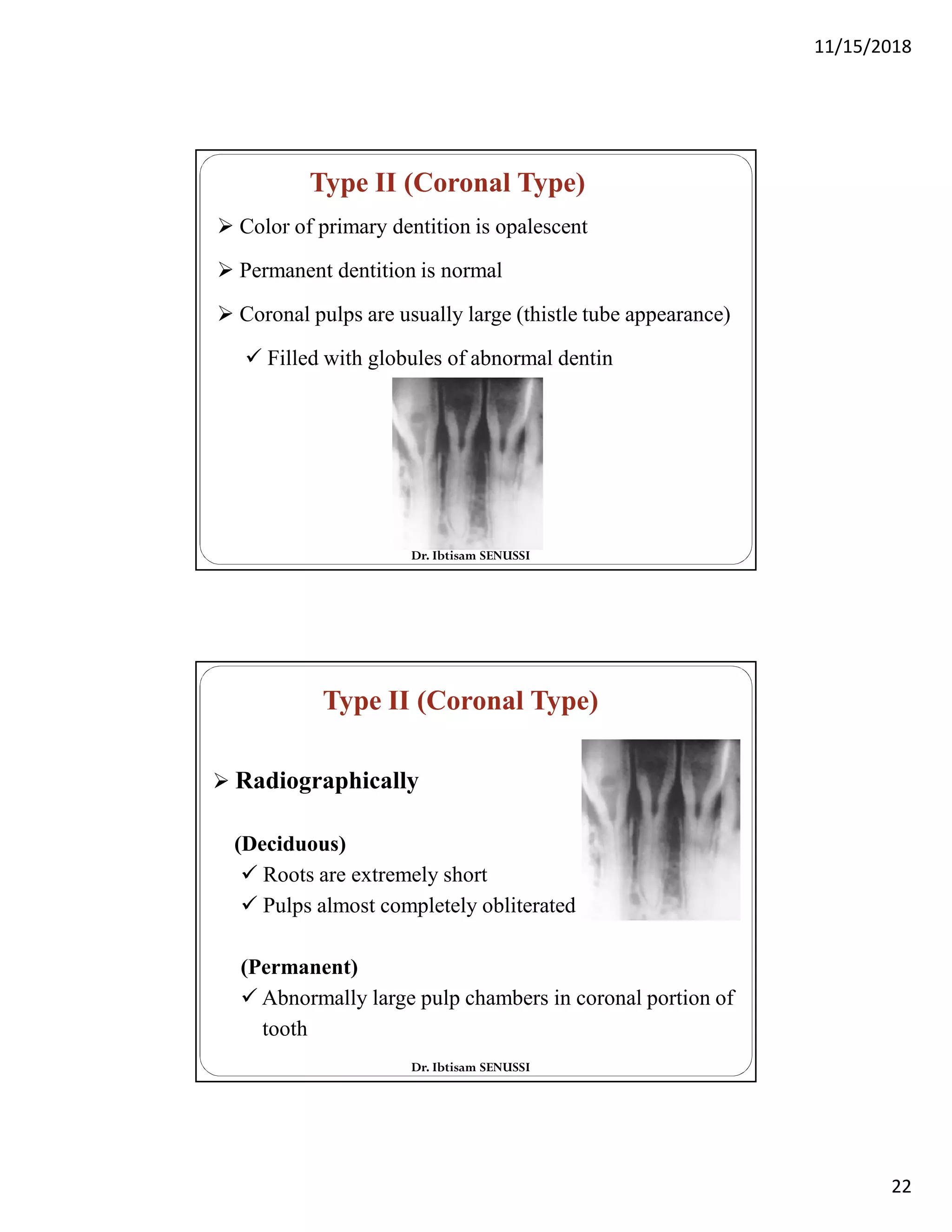 Developmental disturbances - Oral Pathology | PDF