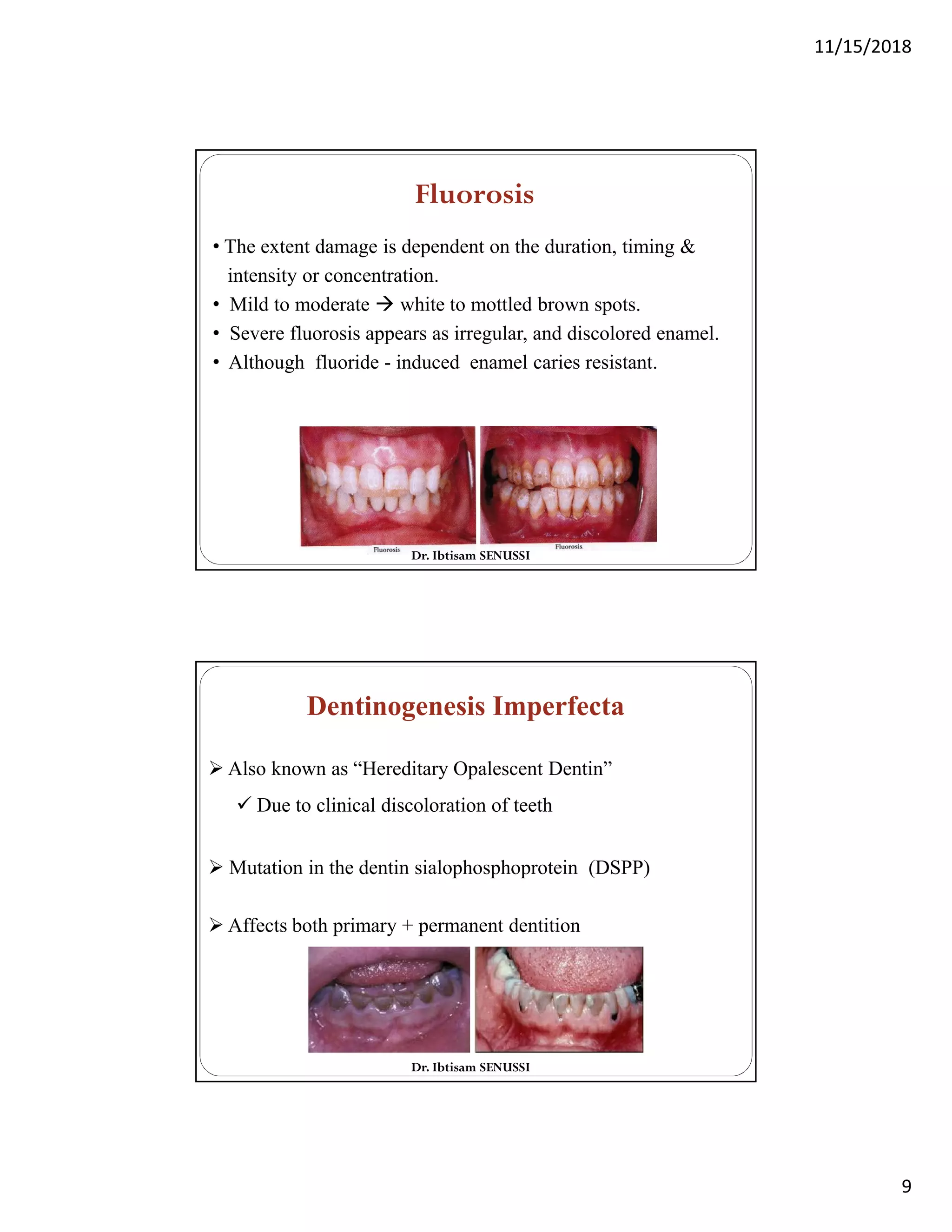 Developmental disturbances - Oral Pathology | PDF