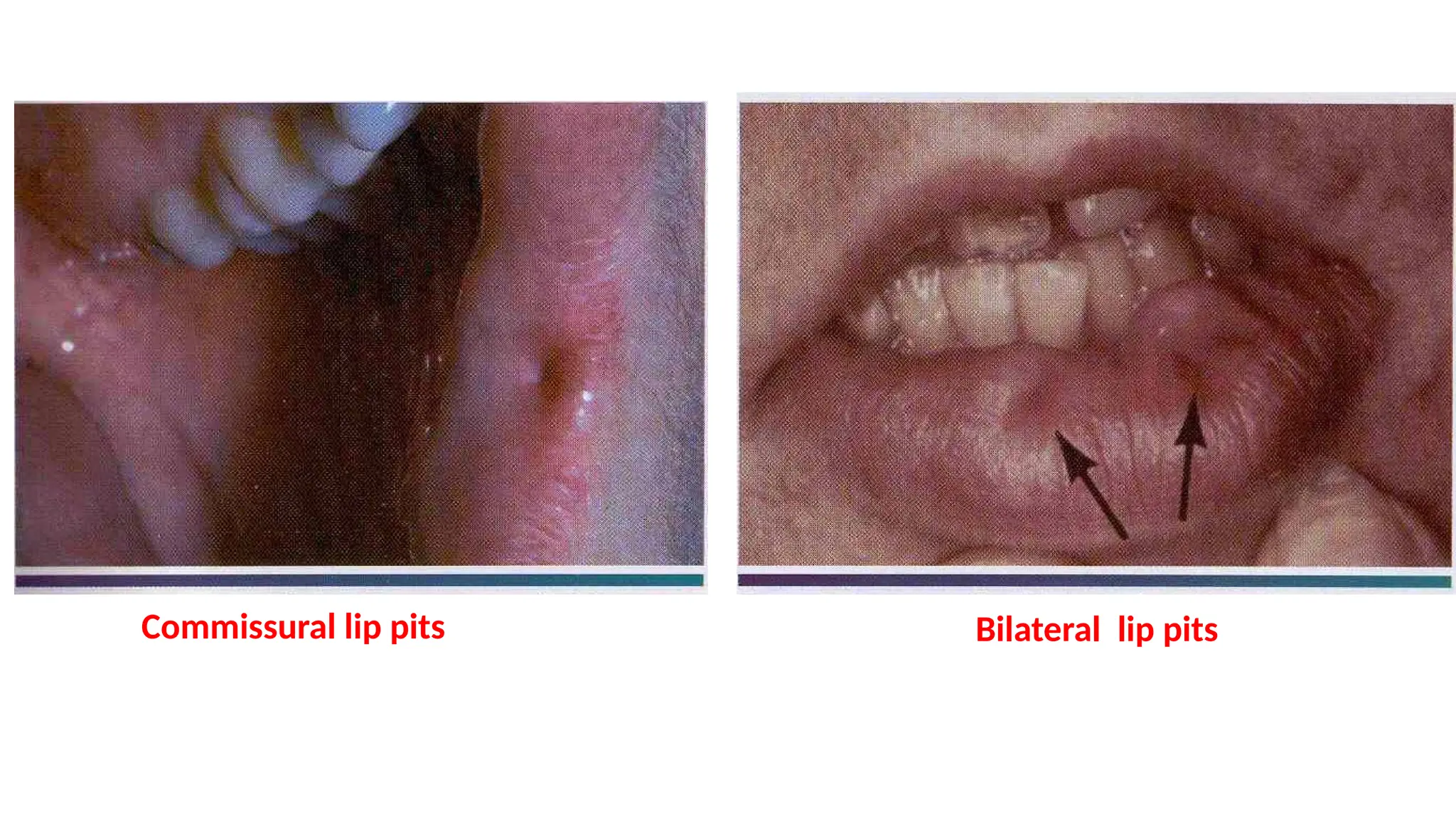 DEVELOPMENTAL DISTURBANCES AFFECTING LIP AND PALATE.pptx