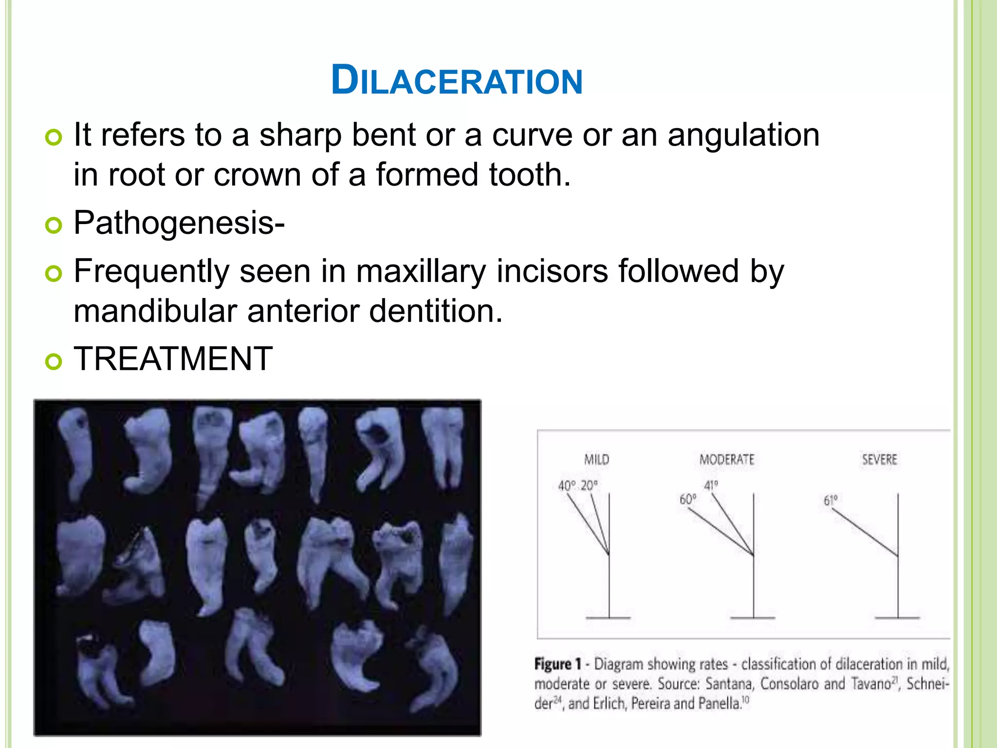 Developmental Disturbances in Shape of Tooth | PPTX