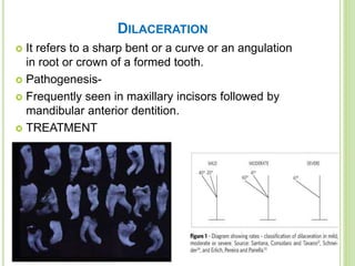 Developmental Disturbances in Shape of Tooth | PPTX