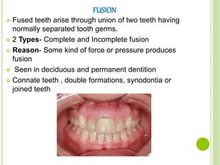 Developmental Disturbances in Shape of Tooth | PPTX