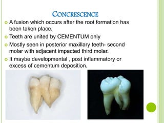Developmental Disturbances in Shape of Tooth | PPTX
