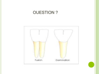 Germination Teeth
