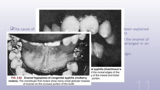 Developmental disturbances in structure - Enamel Hypoplasia.pptx