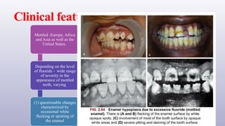 Developmental disturbances in structure - Enamel Hypoplasia.pptx