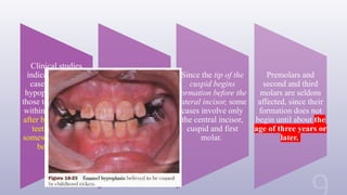 Developmental disturbances in structure - Enamel Hypoplasia.pptx