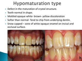 Developmental disturbances in structure of teeth | PPTX
