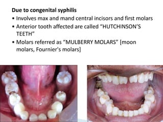 Developmental disturbances in structure of teeth | PPTX