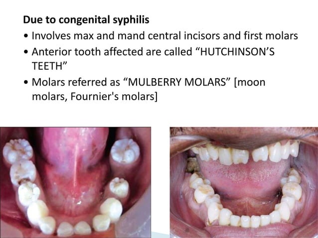 Developmental disturbances in structure of teeth | PPTX | Dental Health ...