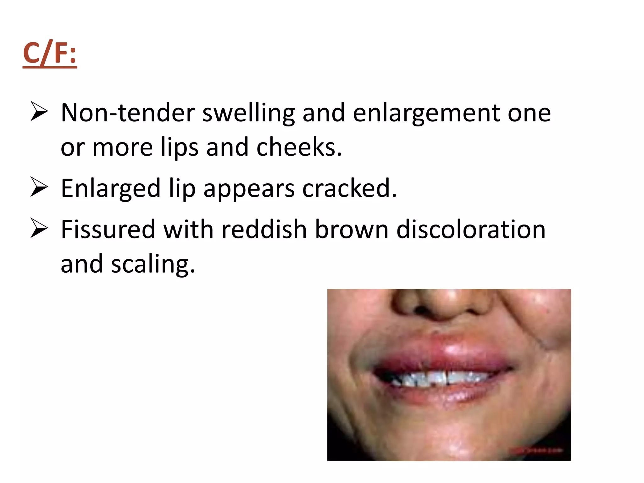 Developmental disturbances of LIP,PALATE and ORAL MUCOSA | PPTX