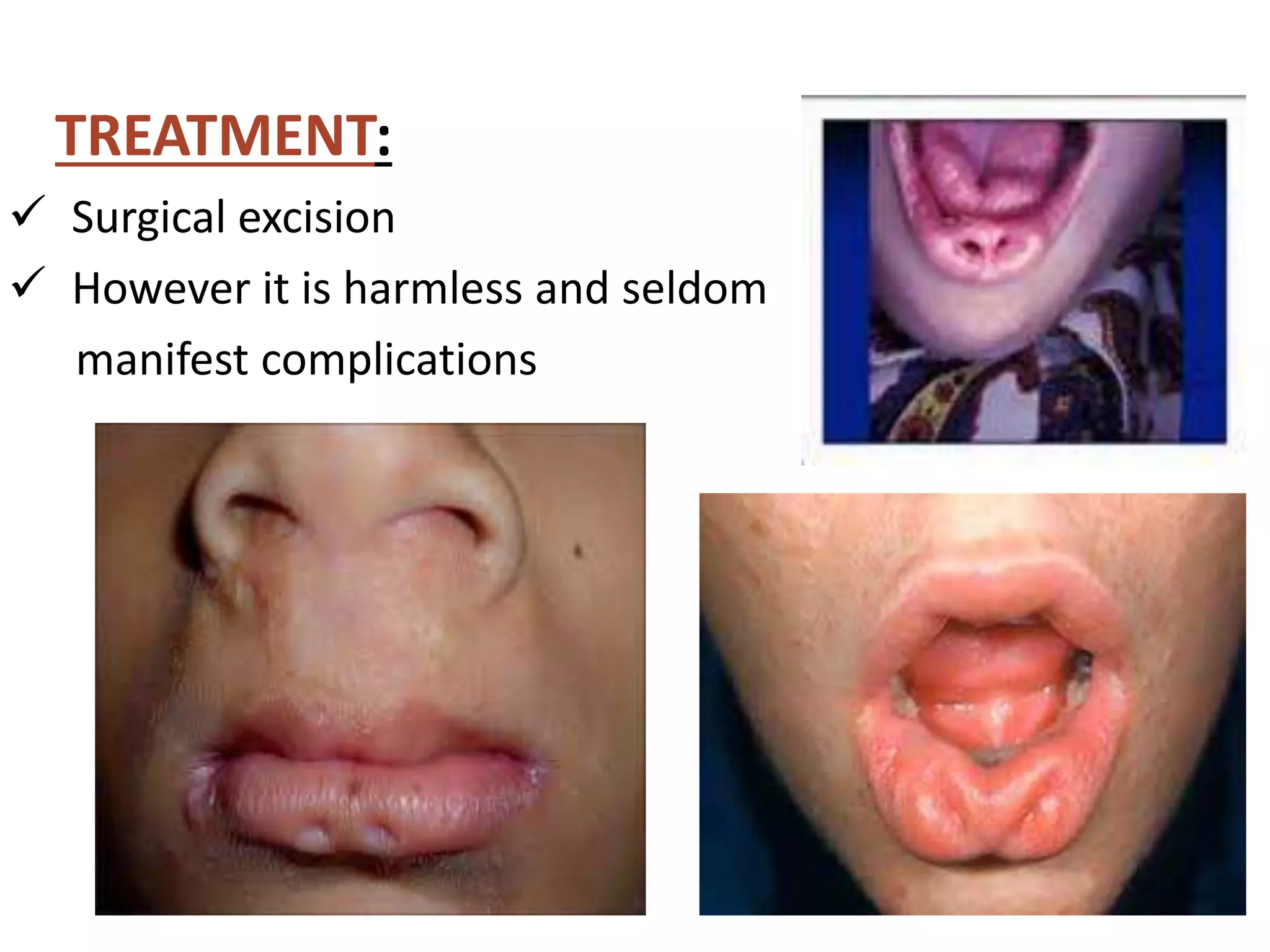 Developmental disturbances of LIP,PALATE and ORAL MUCOSA | PPTX