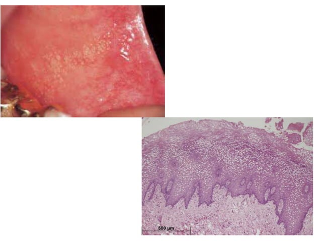 Developmental disturbances of LIP,PALATE and ORAL MUCOSA | PPTX | Ear ...