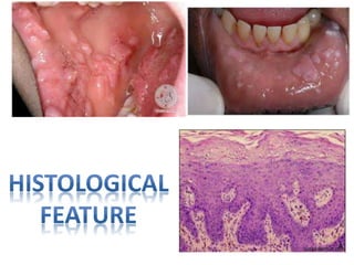 Developmental disturbances of LIP,PALATE and ORAL MUCOSA | PPTX