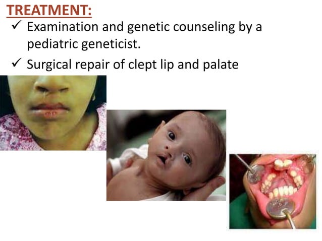 Developmental disturbances of LIP,PALATE and ORAL MUCOSA | PPTX | Ear ...