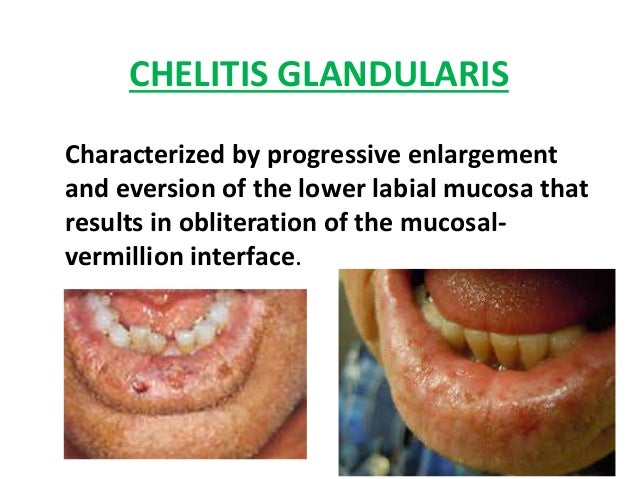 Developmental disturbances of LIP,PALATE and ORAL MUCOSA