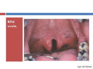 Developmental disturbances of bone signed | PPT