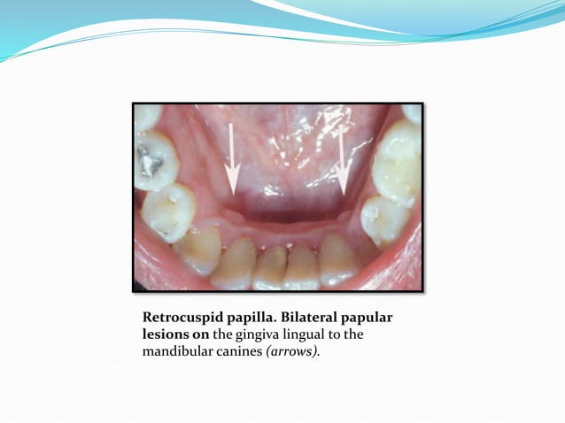 DEVELOPMENTAL DISTURBANCES OF GINGIVA.pptx | Dental Health | Diseases ...