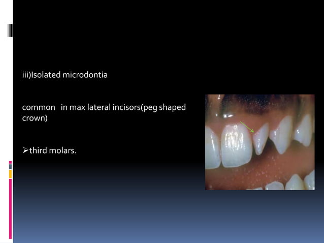 Developmental disturbances of teeth | PPTX | Dental Health | Diseases ...