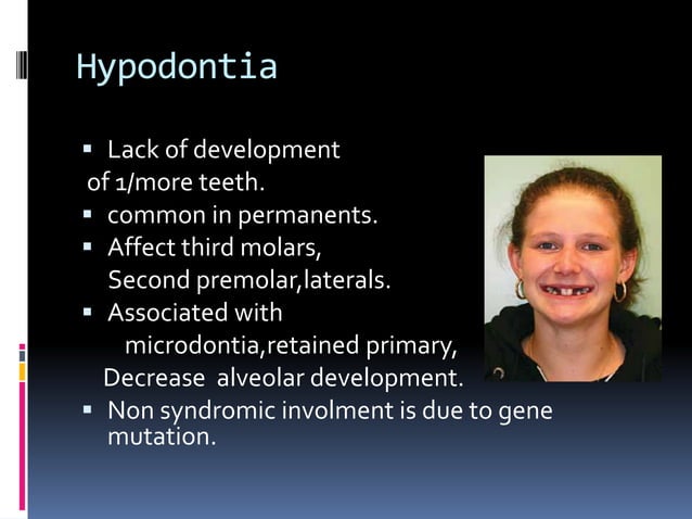 Developmental disturbances of teeth | PPTX | Dental Health | Diseases ...