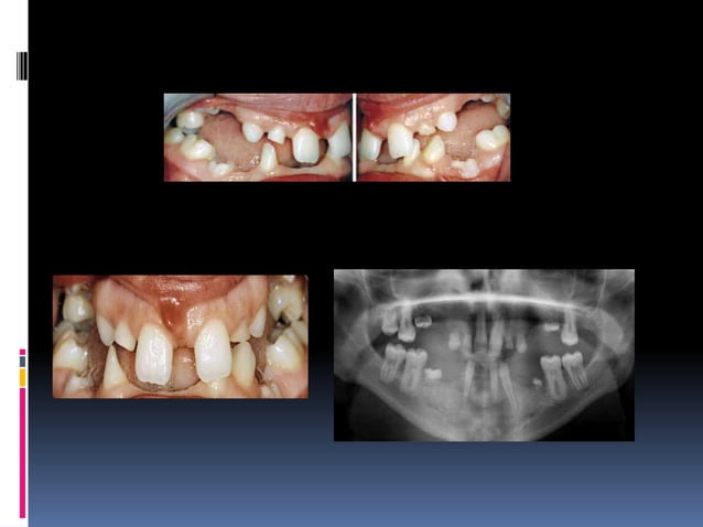 Developmental disturbances of teeth | PPTX | Dental Health | Diseases ...