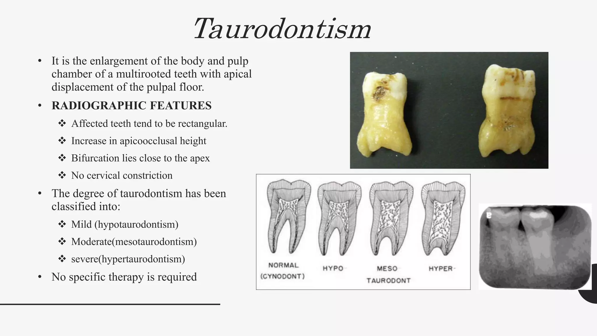 Developmental disturbances of teeth | PPTX