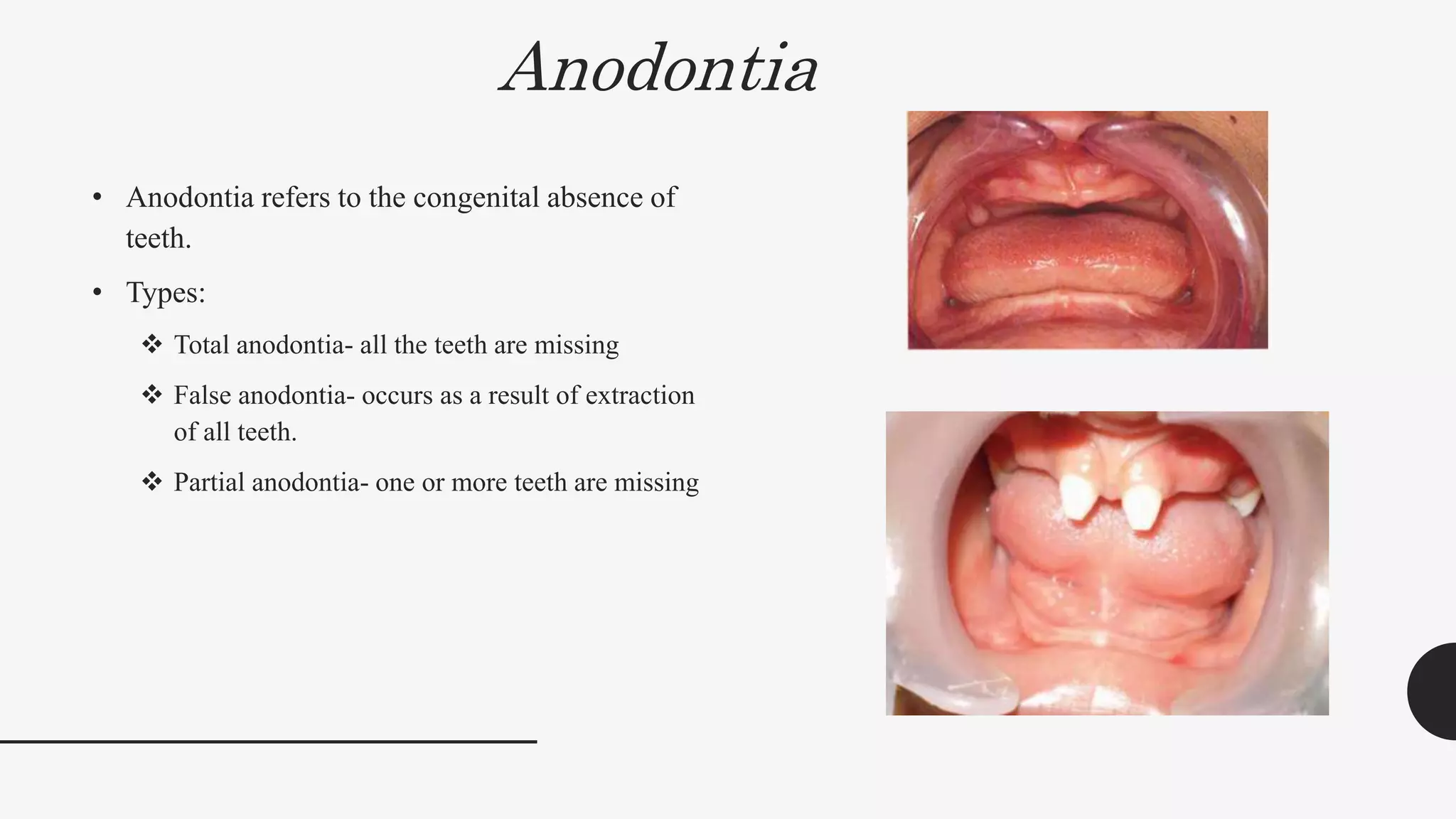 Developmental disturbances of teeth | PPTX