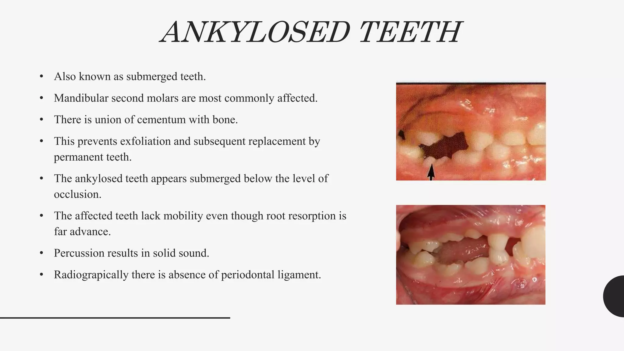 Developmental disturbances of teeth | PPTX