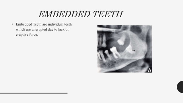 Developmental disturbances of teeth | PPTX