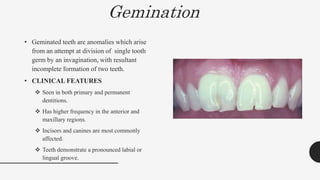 Developmental disturbances of teeth | PPTX