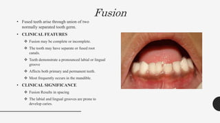 Fusion Teeth