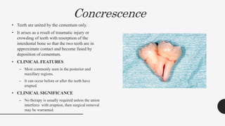 Concrescence Teeth