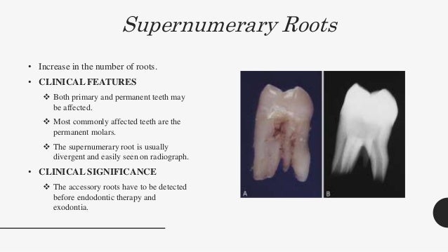 Developmental disturbances of teeth