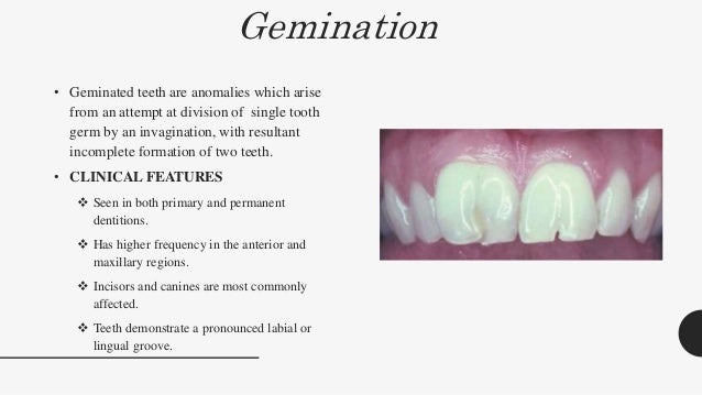 Developmental disturbances of teeth