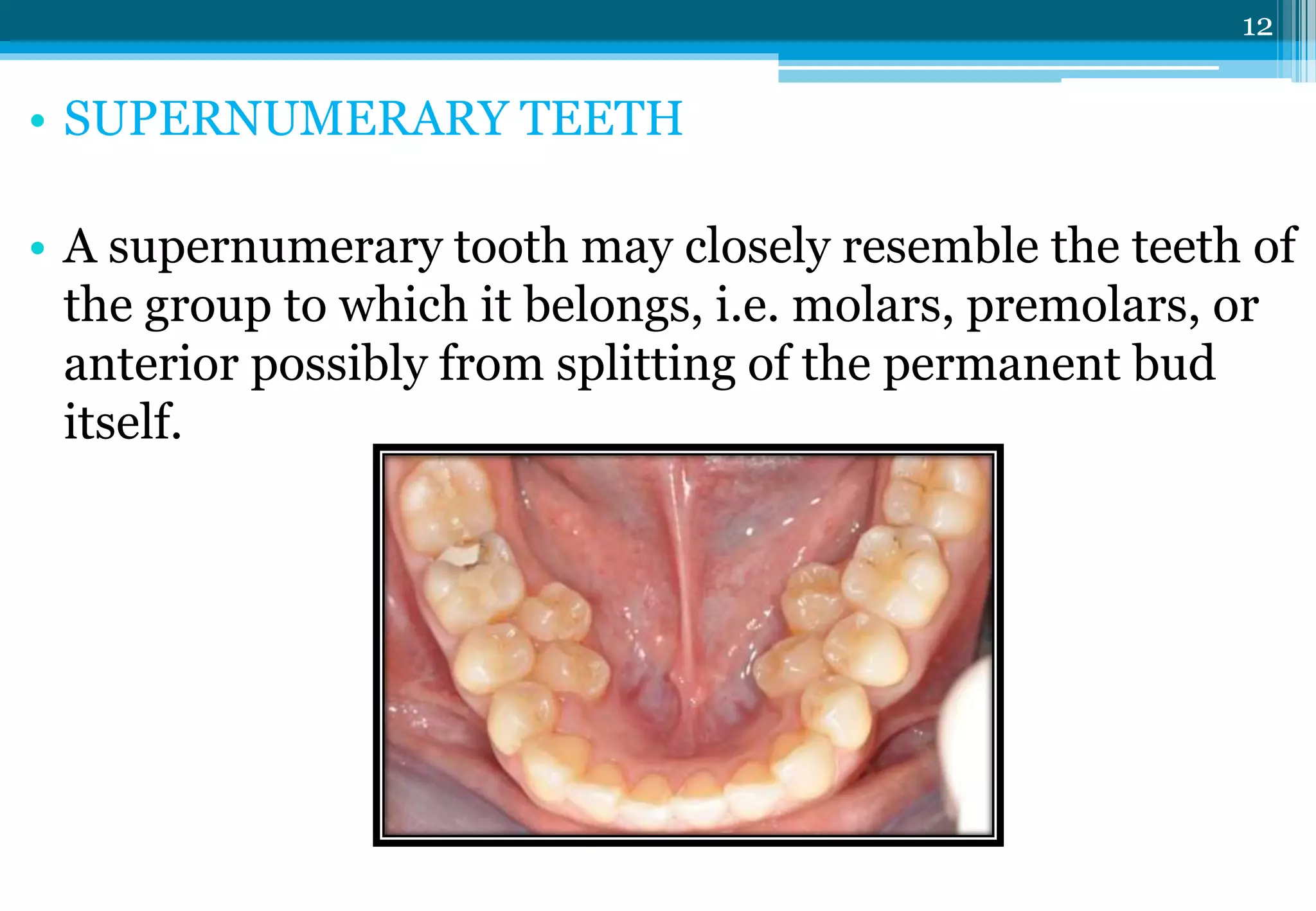 developmental disturbances of teeth.pptx