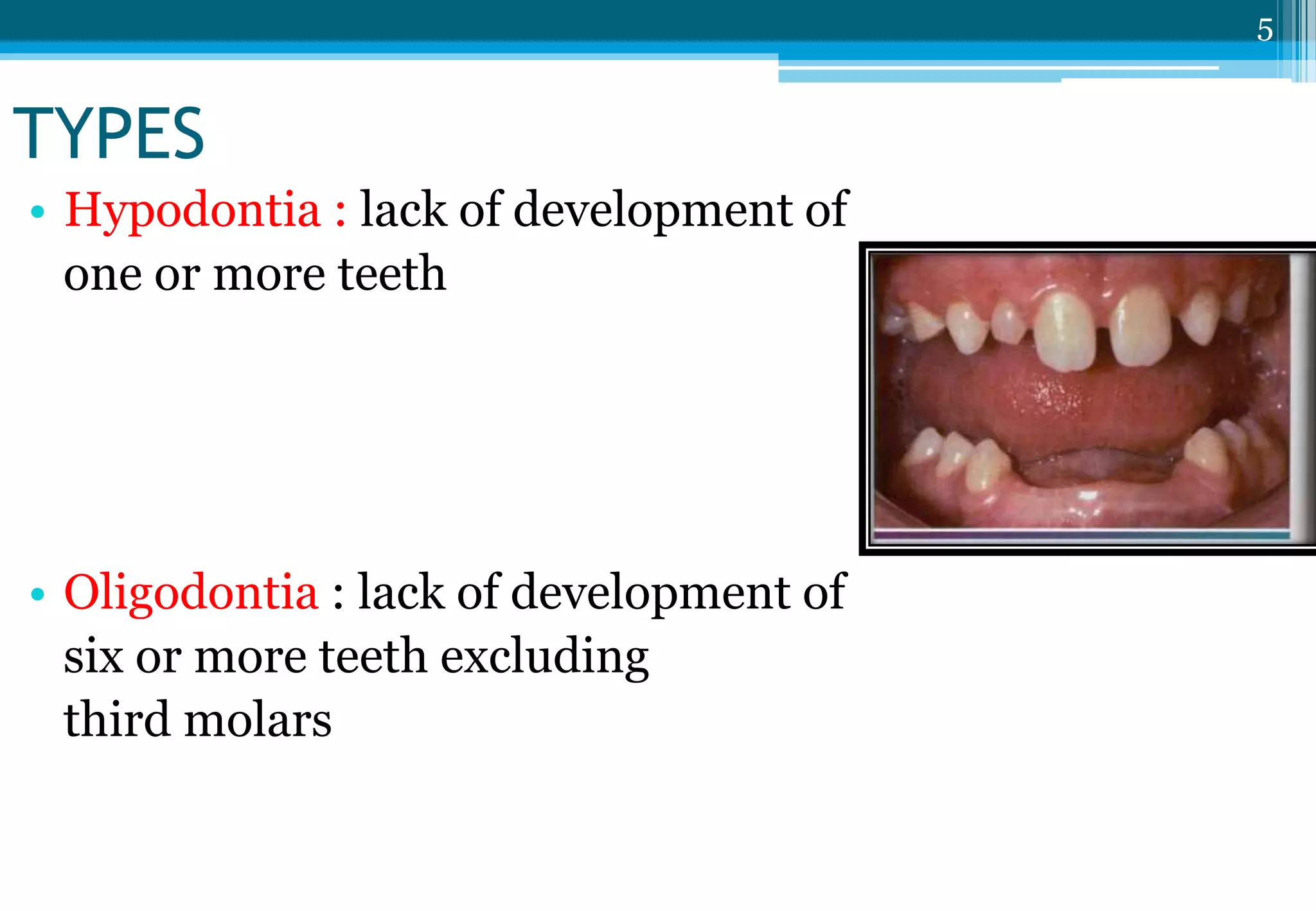 developmental disturbances of teeth.pptx