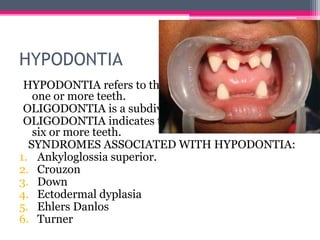 Developmental disturbances of teeth | PPT