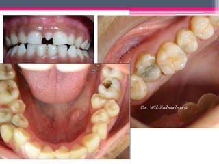 Developmental disturbances of teeth | PPT