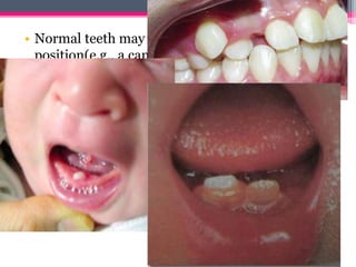 Developmental disturbances of teeth | PPT