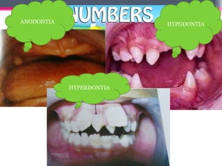Developmental disturbances of teeth | PPT