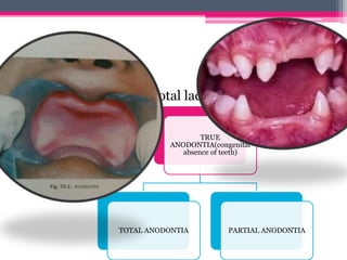 Developmental disturbances of teeth | PPTX