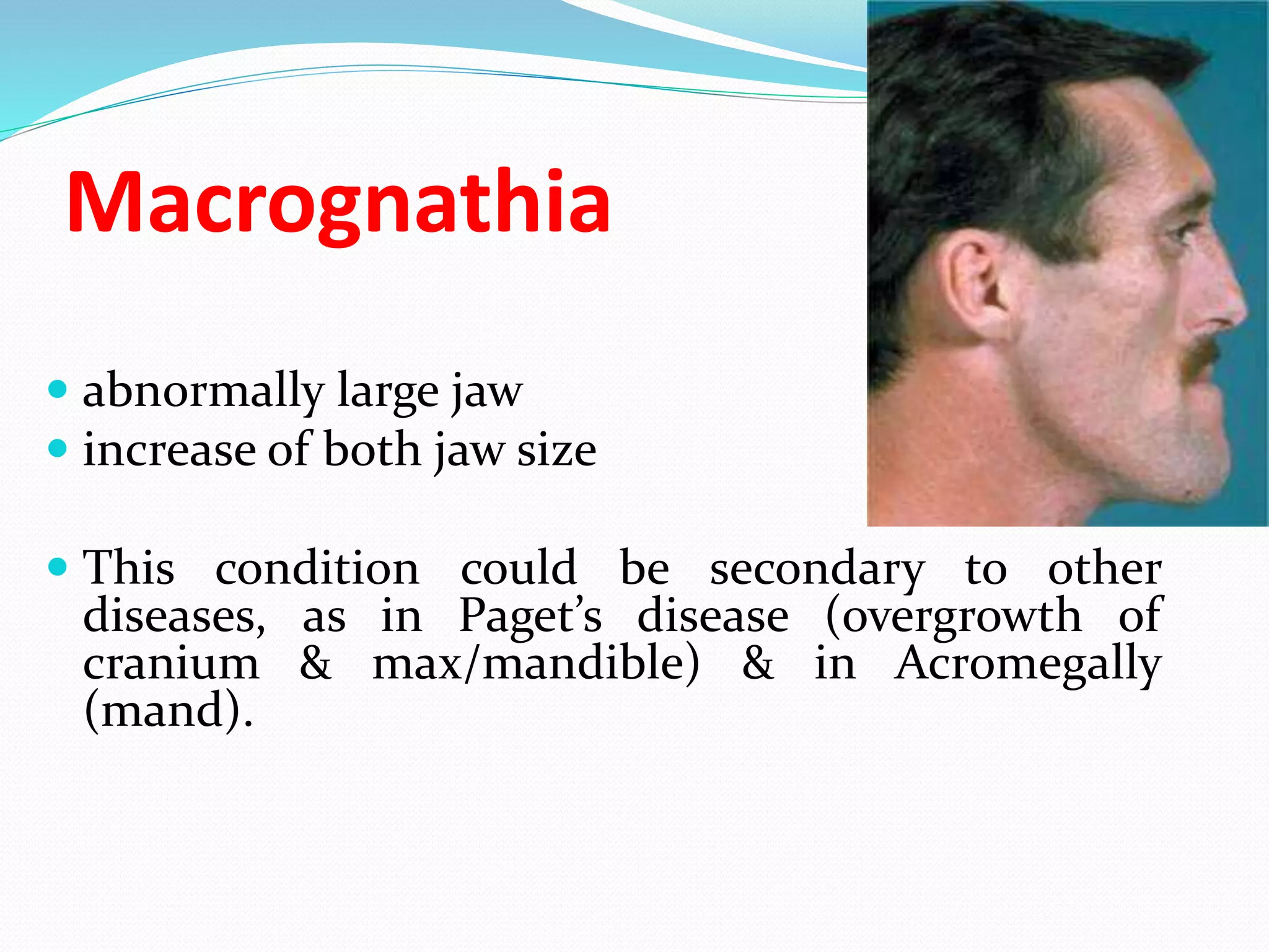 Developmental disturbances of the jaws | PPTX