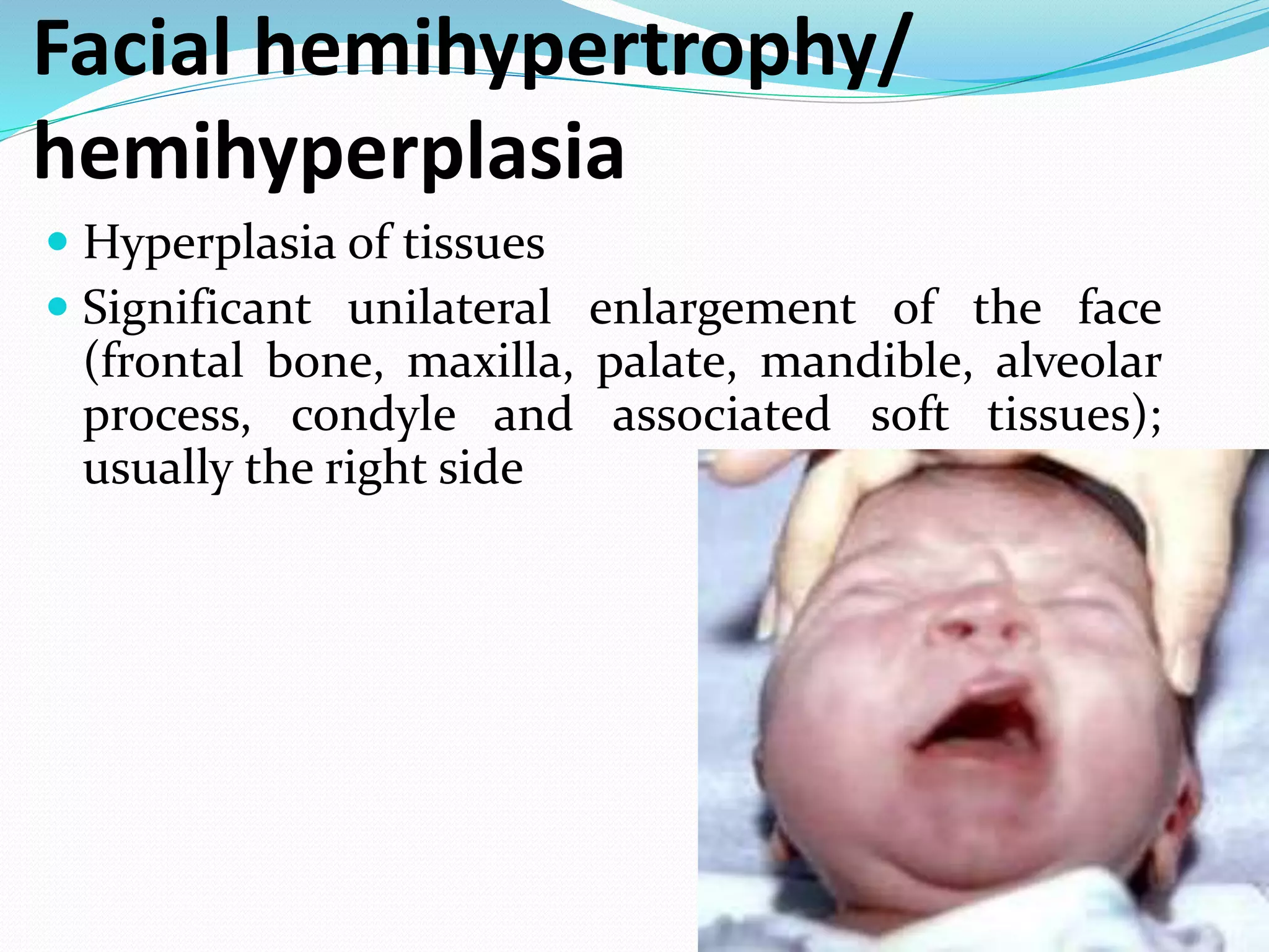 Developmental disturbances of the jaws | PPTX