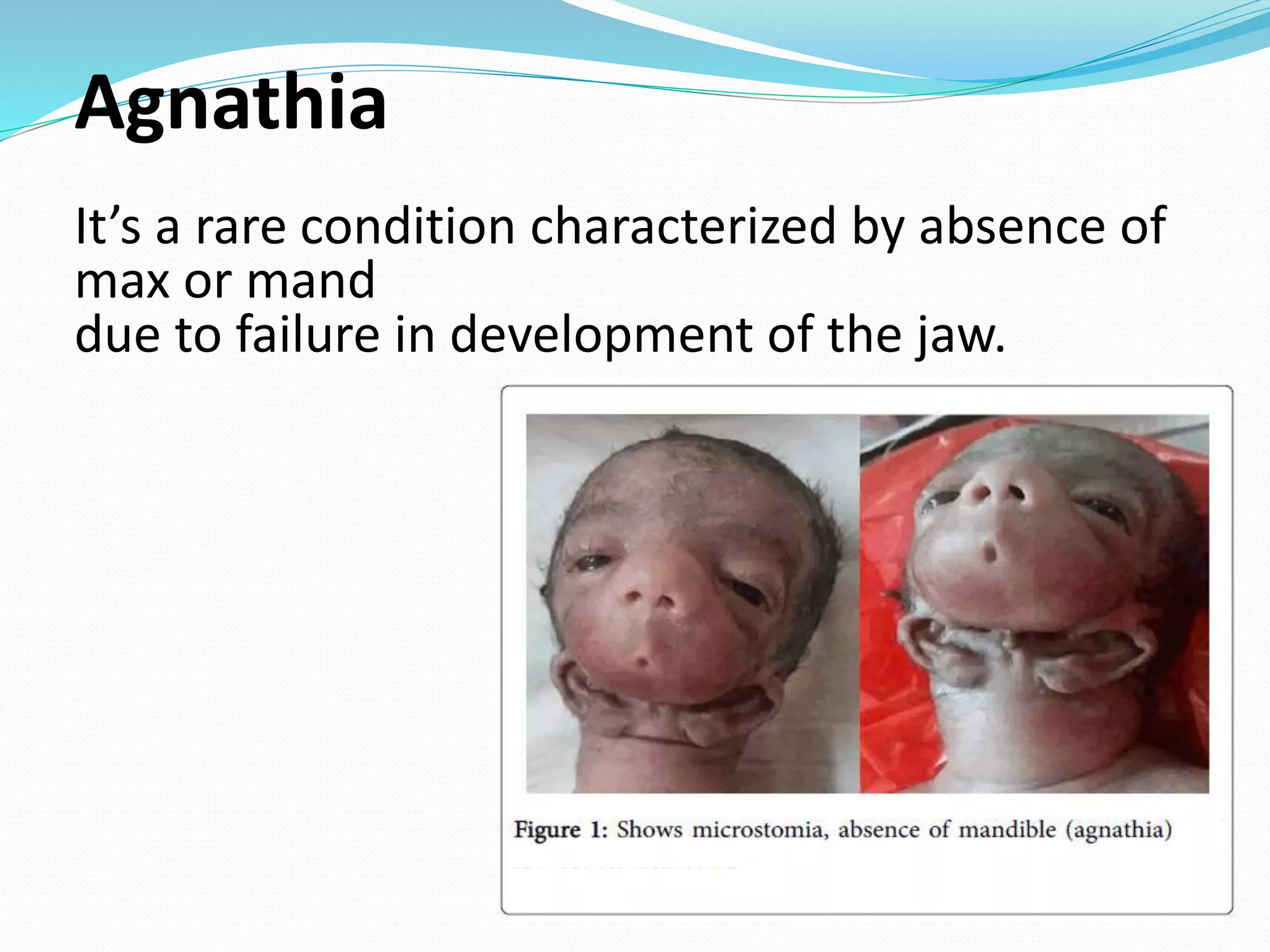 Developmental disturbances of the jaws | PPTX