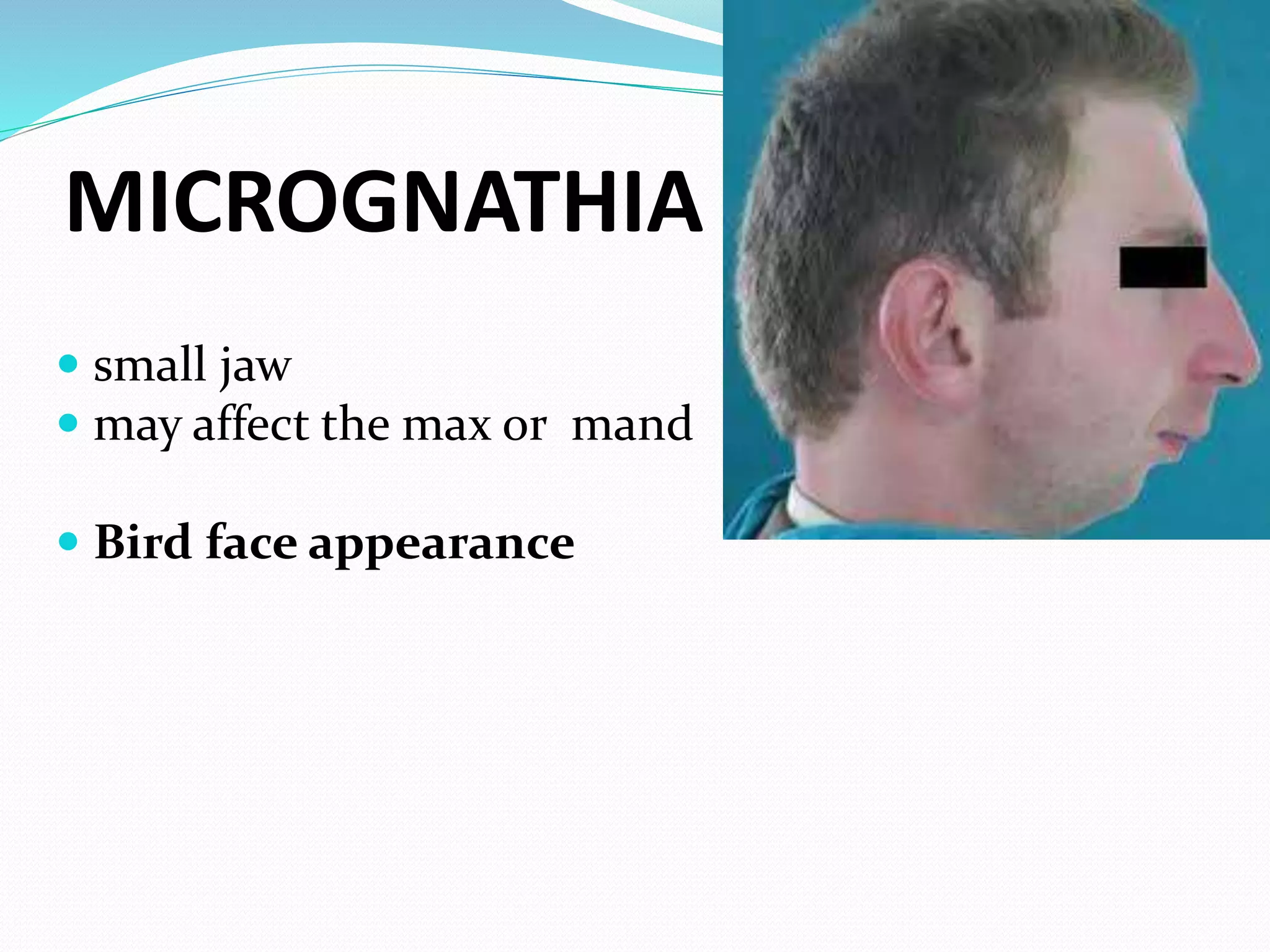 Developmental disturbances of the jaws | PPTX